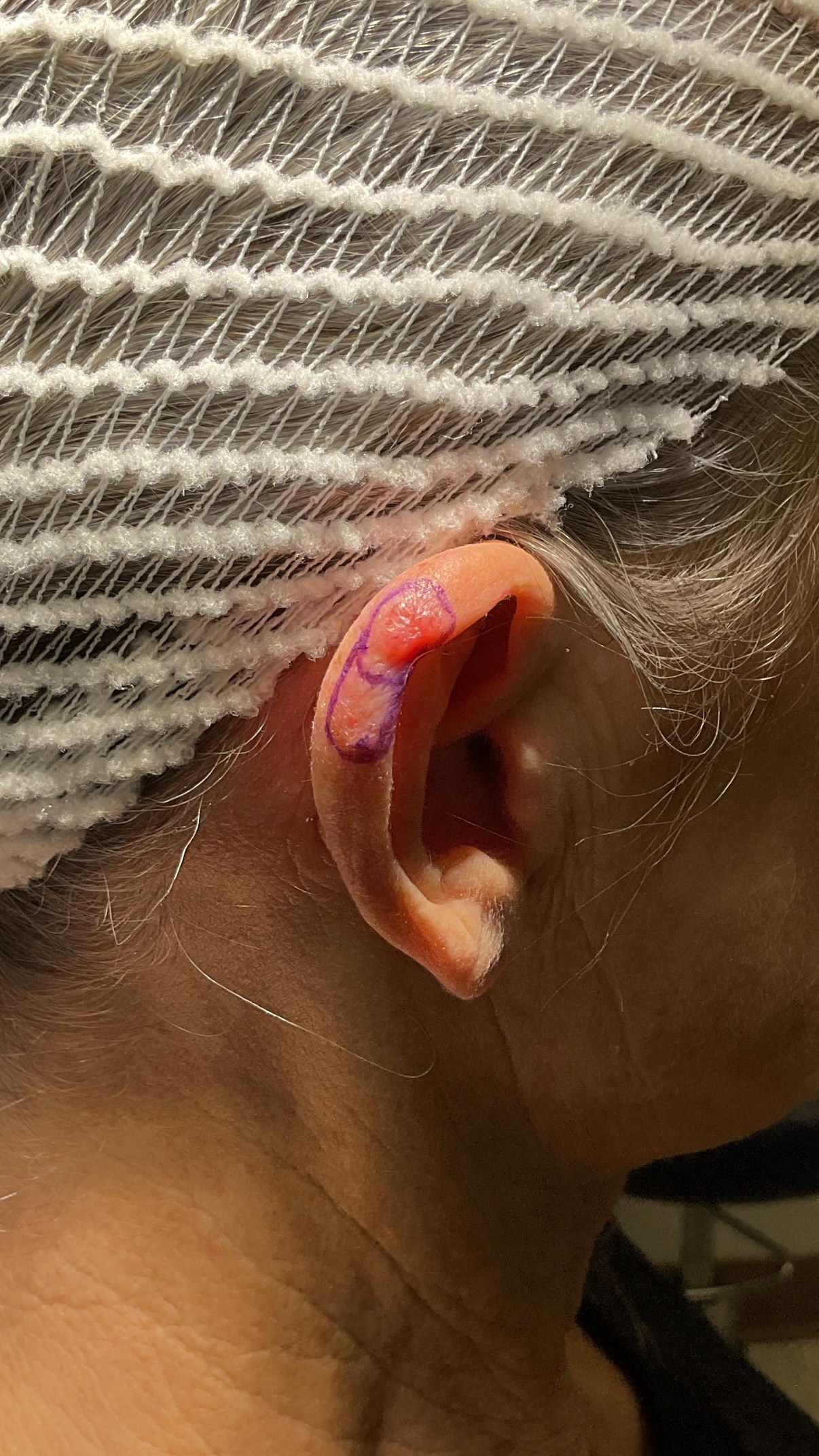 Ear | ACMS - American College of Mohs Surgery