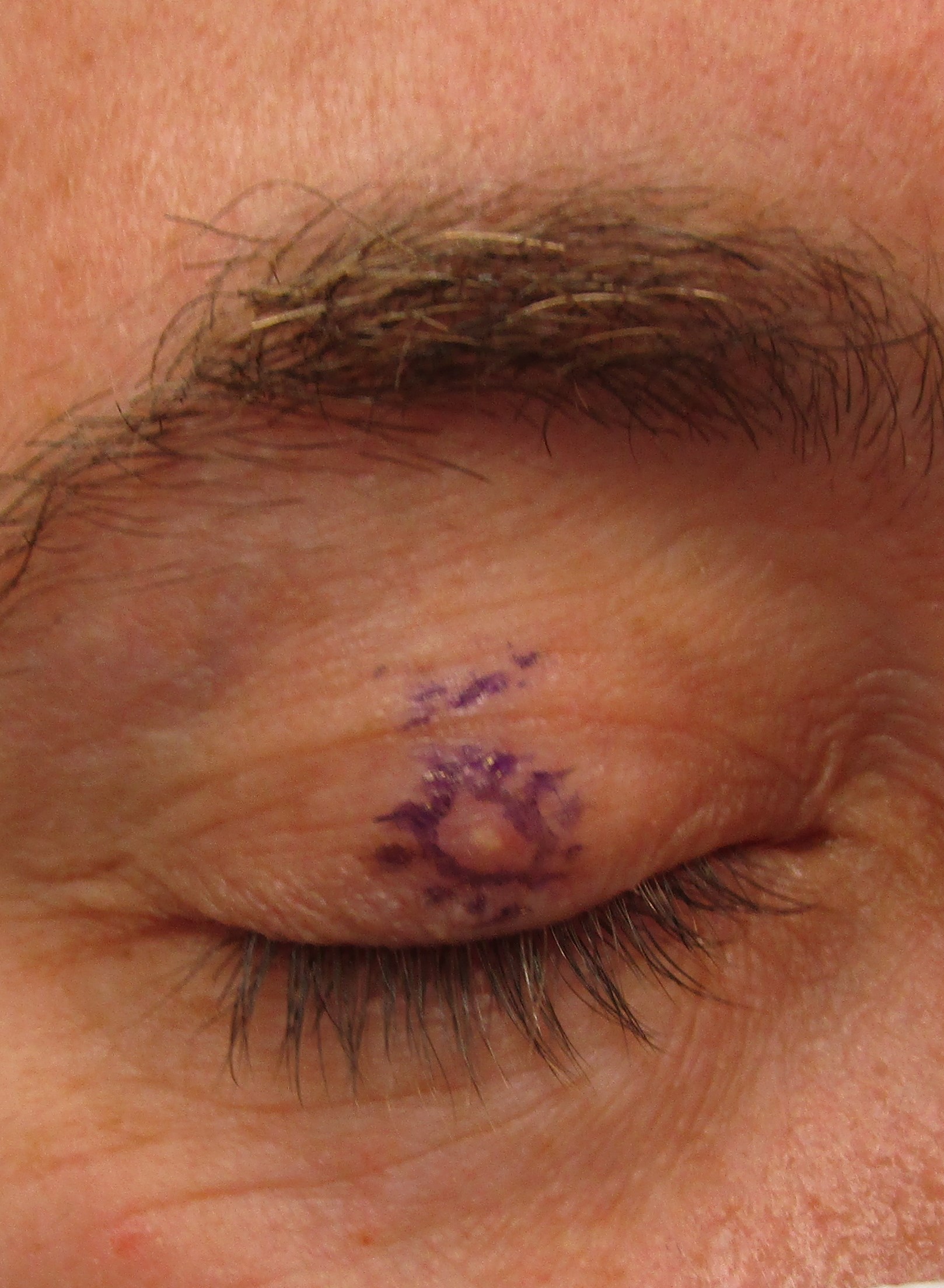 Eyelid | ACMS - American College of Mohs Surgery