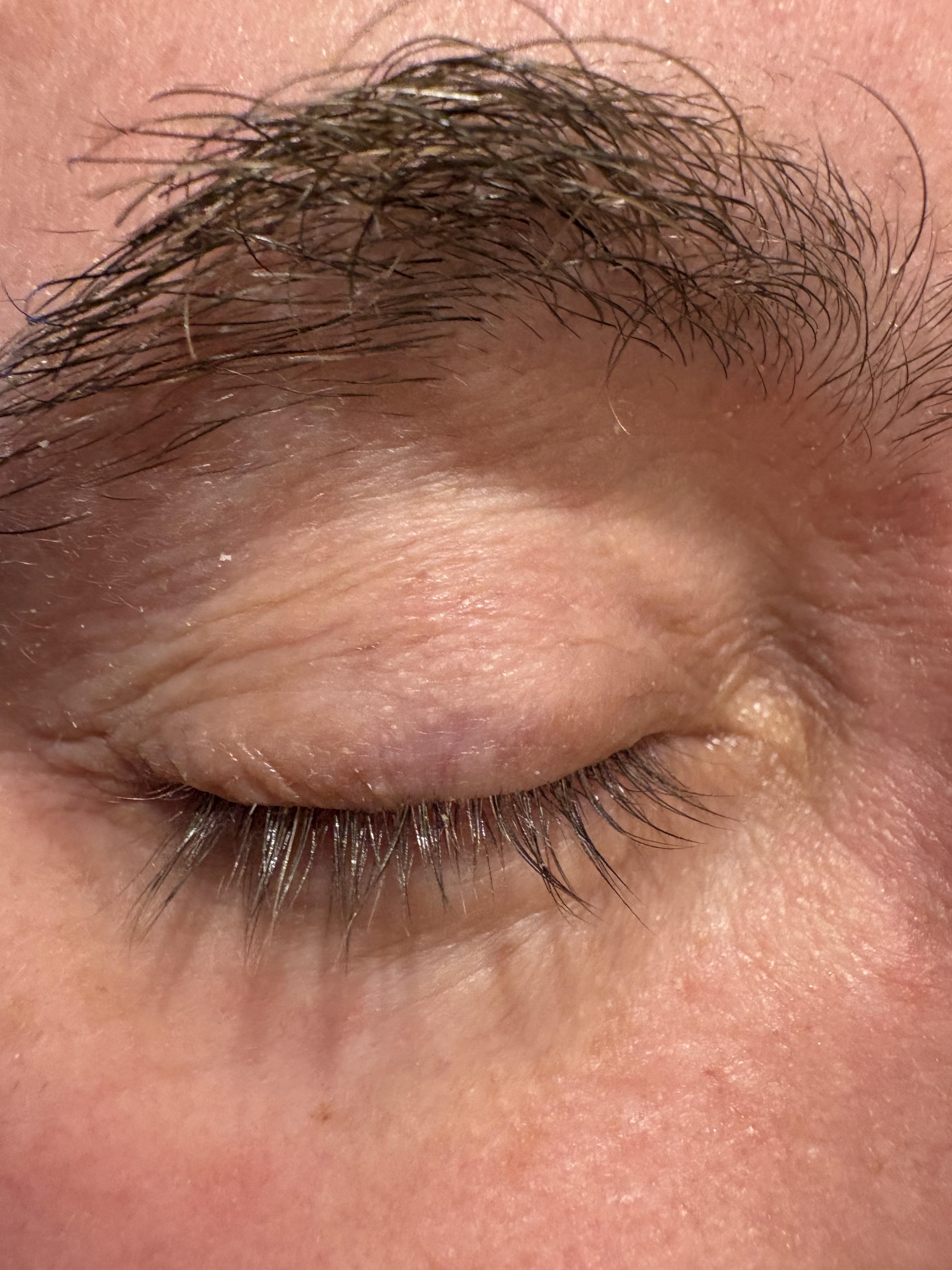 Eyelid | ACMS - American College of Mohs Surgery
