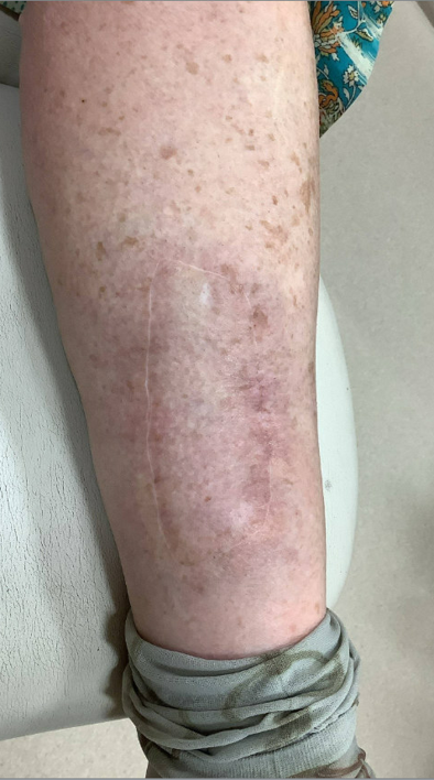 Lower Leg | ACMS - American College of Mohs Surgery