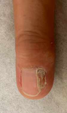 Nail/Finger | ACMS - American College of Mohs Surgery