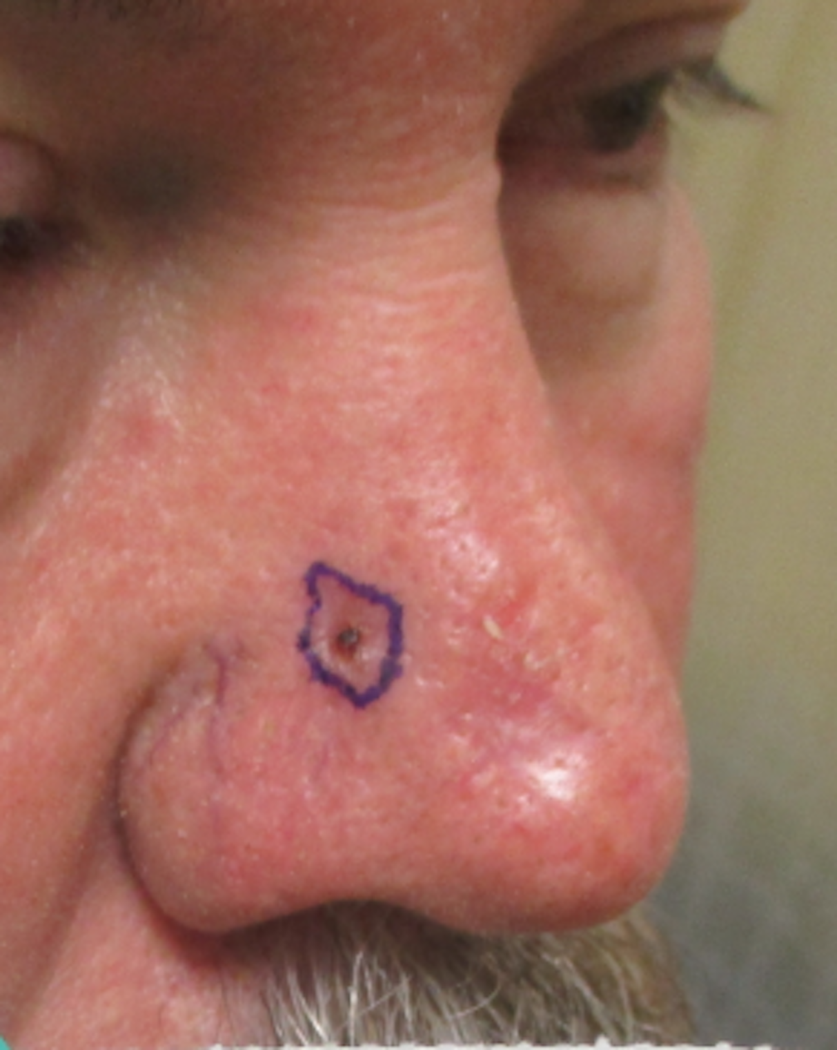 Nose | ACMS - American College of Mohs Surgery