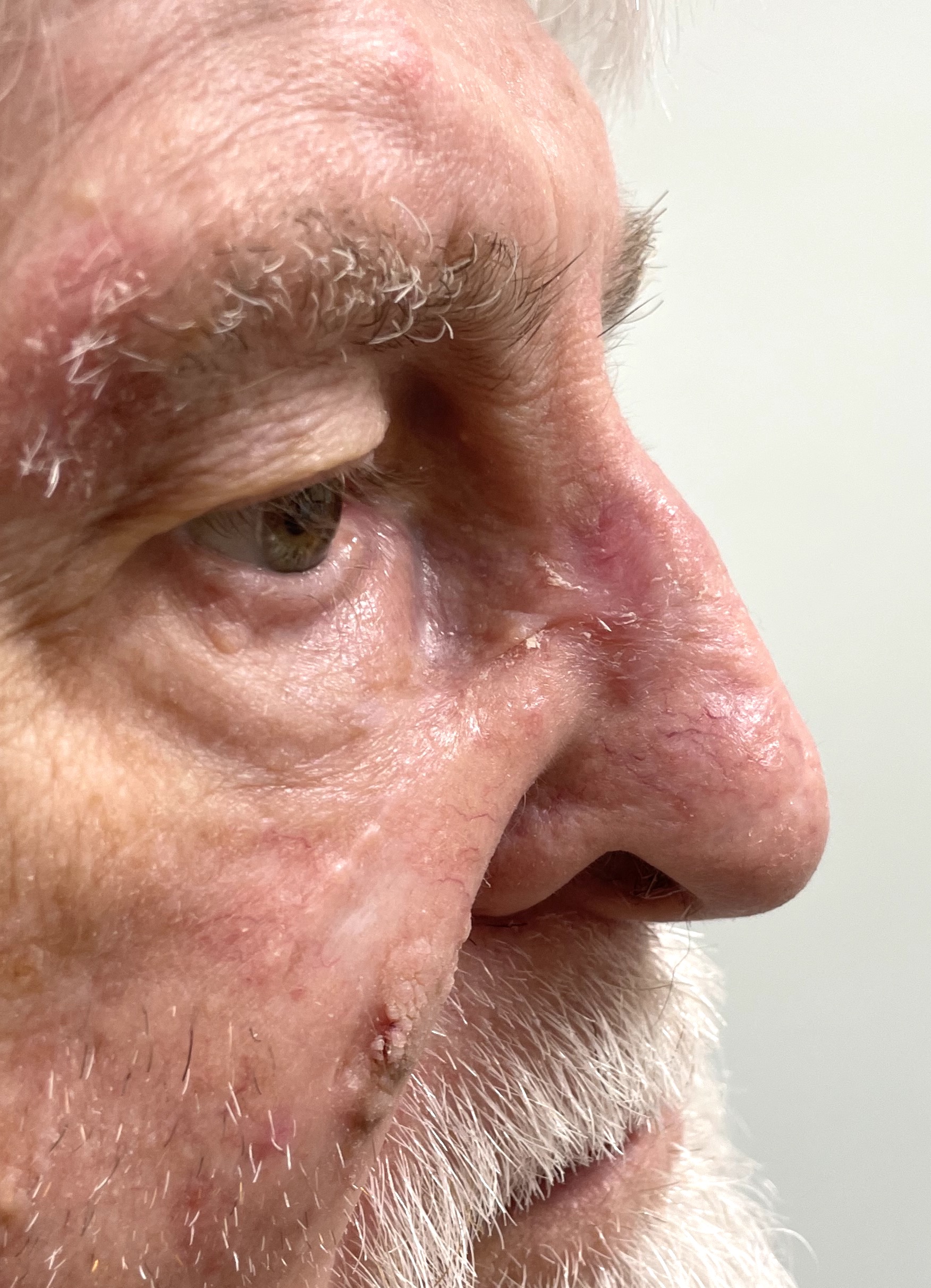 Nose | ACMS - American College of Mohs Surgery